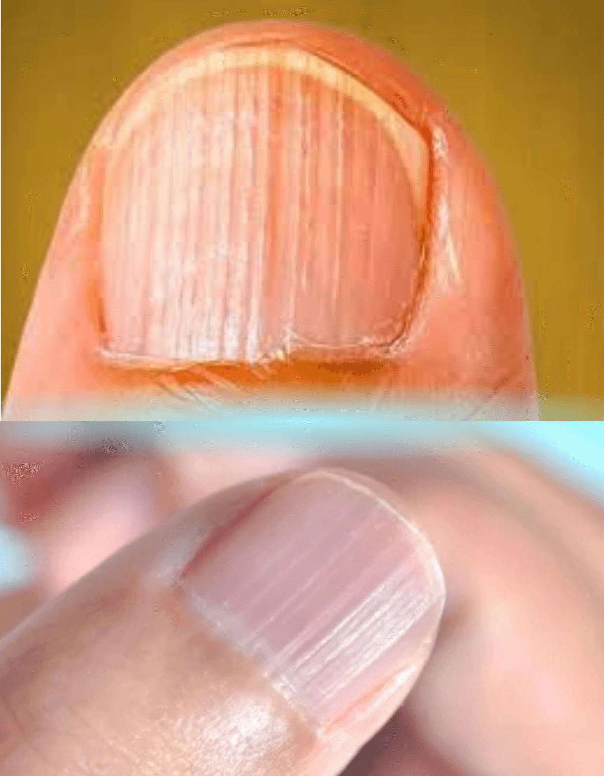 Rippled Fingernails May Indicate Underlying Health Conditions - Natural ...
