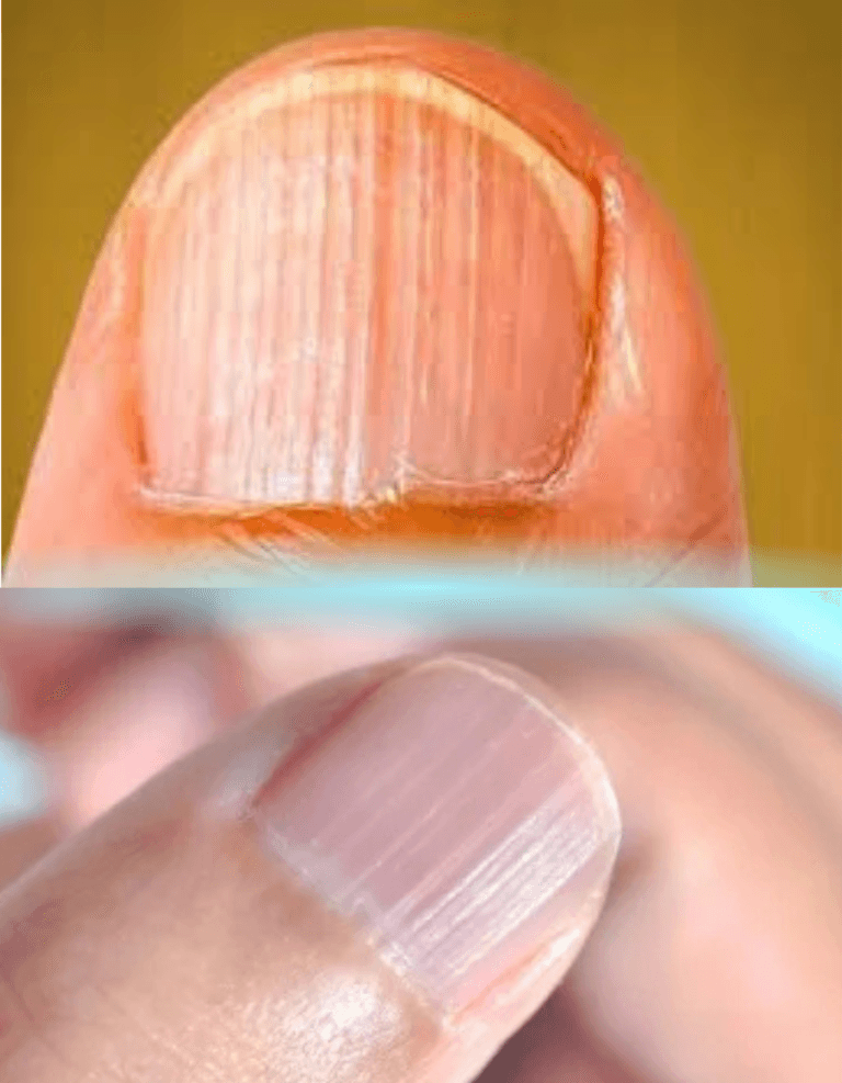 Rippled Fingernails May Indicate Underlying Health Conditions - Natural ...